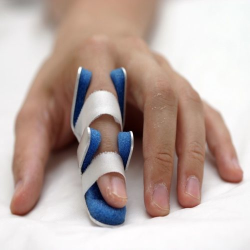 How Long Does It Take a Sprained Finger to Heal? - Within Normal Limits